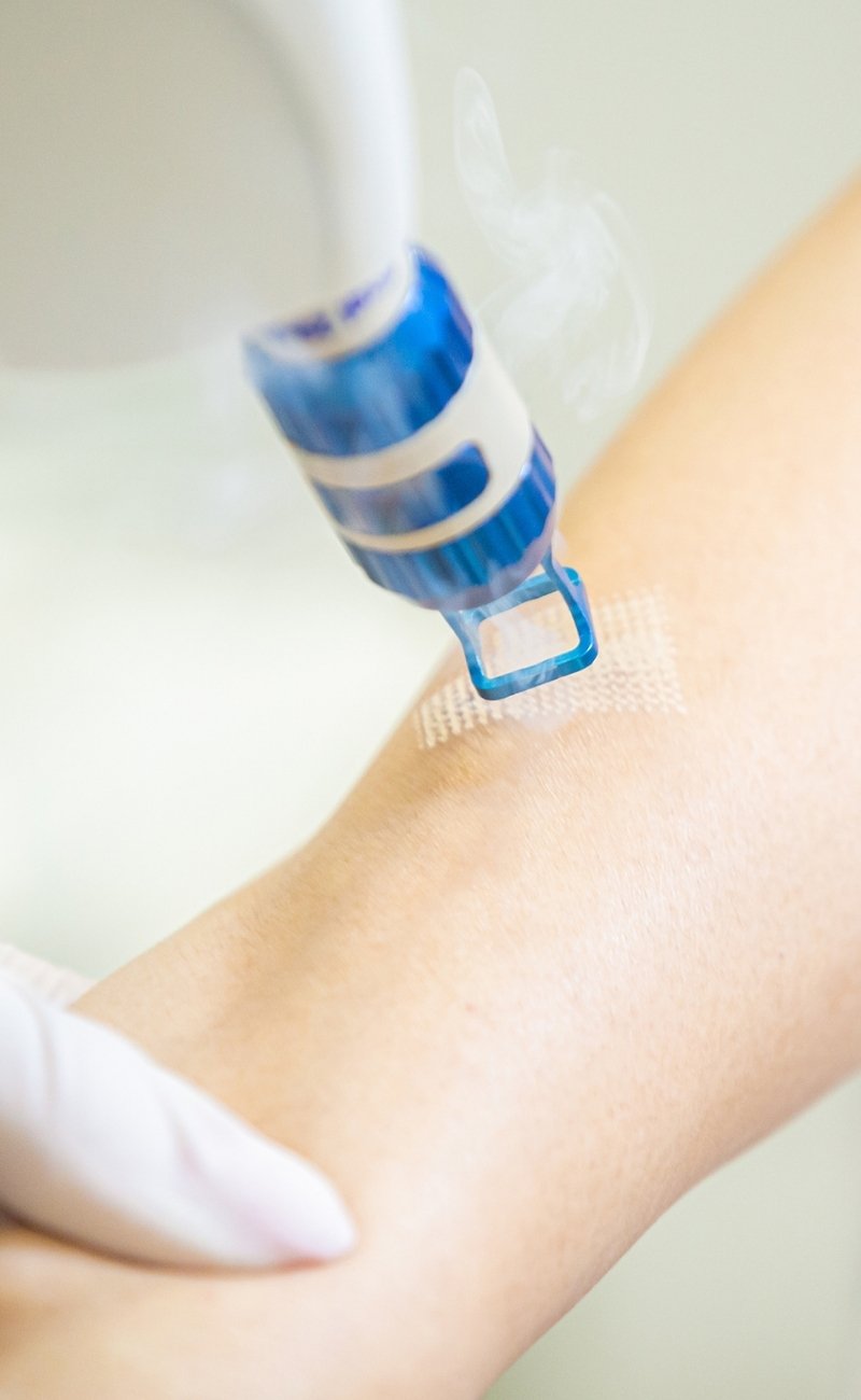 Fractional Laser Body | TheAntiagers - Αισθητικές λύσεις - Πλαστική ...